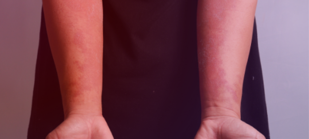 Skin Barrier Dysfunction in Early Childhood Atopic Dermatitis