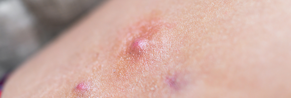 Top 3 Clinical Outcome Assessments in Hidradenitis Suppurativa (HS) Trials